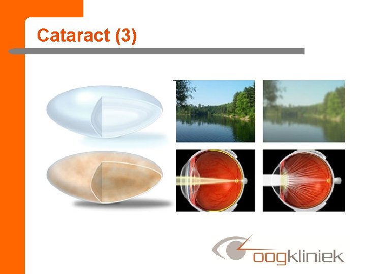 OOGAANDOENINGEN BIJ RHEUMATOIDE ARTHRITIS Dr K Vanhoucke Oogarts