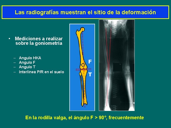 La rodilla valga La rodilla valga Definicin Anlisis