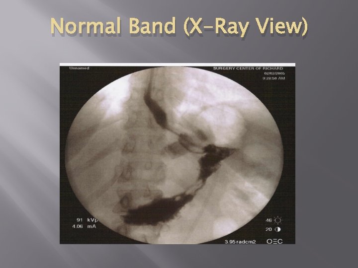 Post Operative CareConsiderations of the Bariatric Patient in