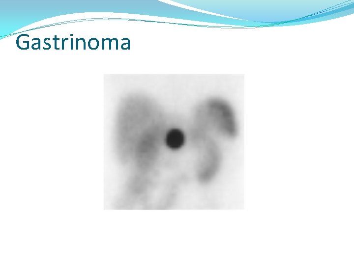 PEPTIDE RECEPTOR IMAGING Tumor cells despite their seemingly