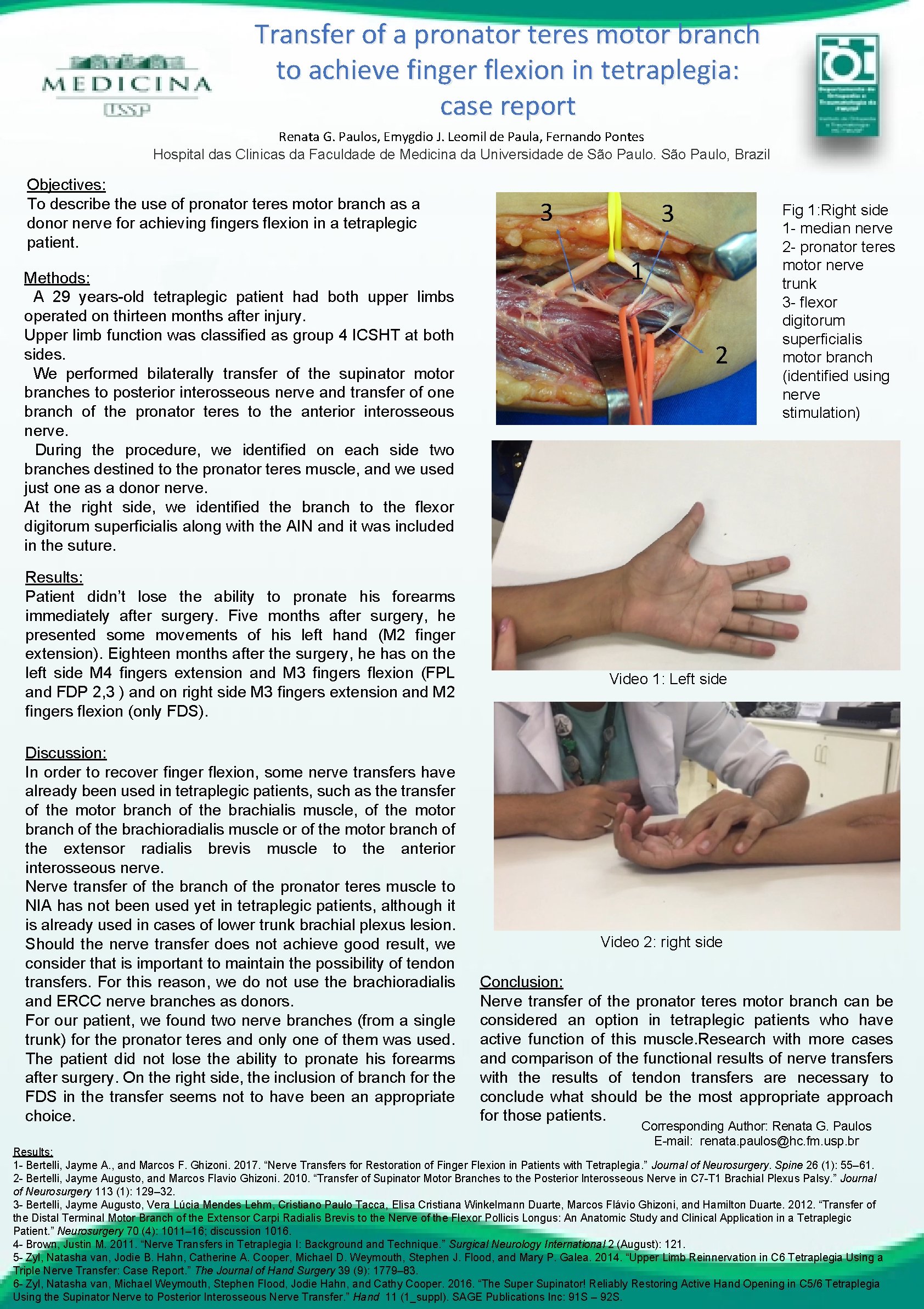 Transfer of a pronator teres motor branch to
