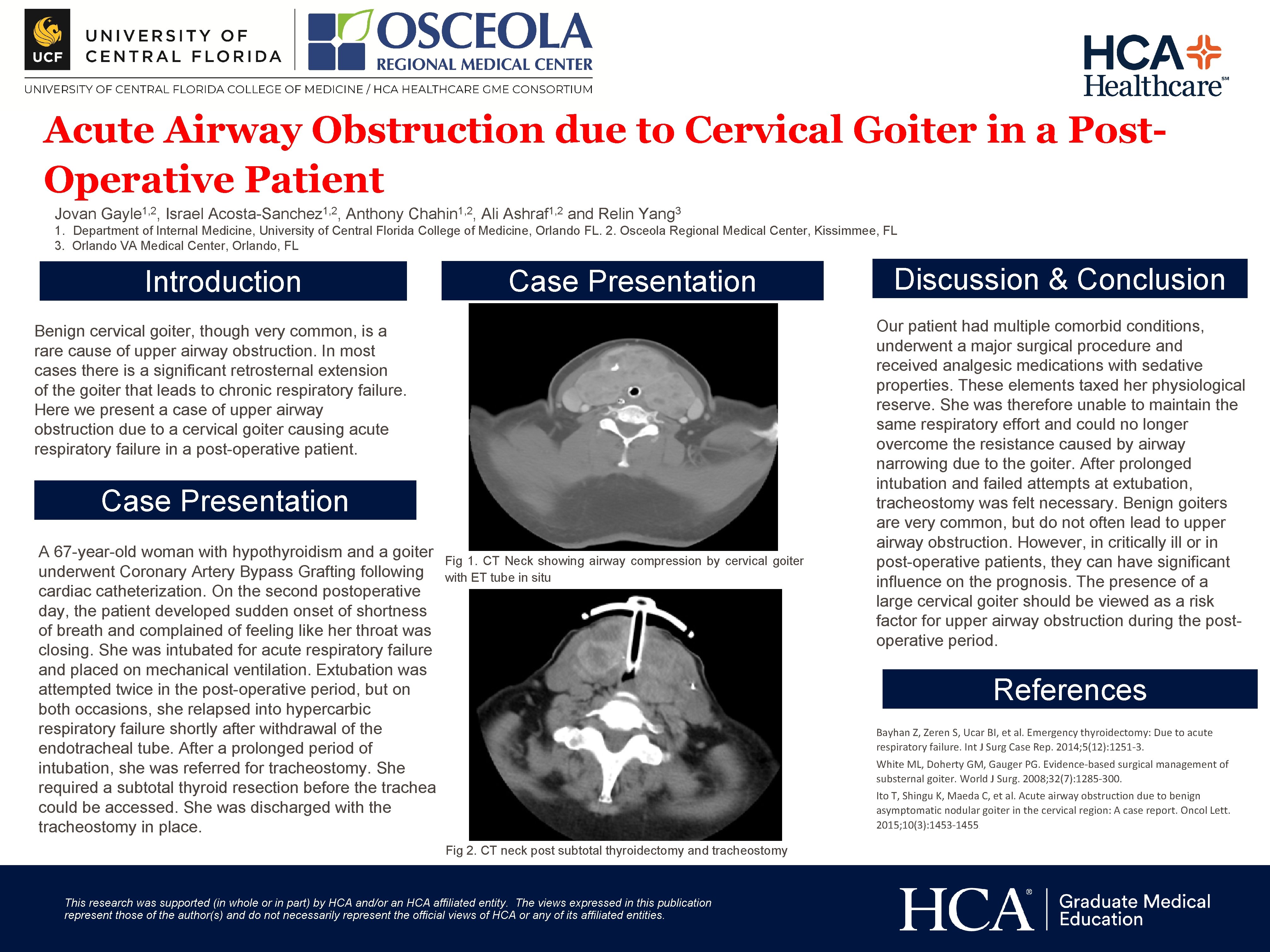 Acute Airway Obstruction due to Cervical Goiter in
