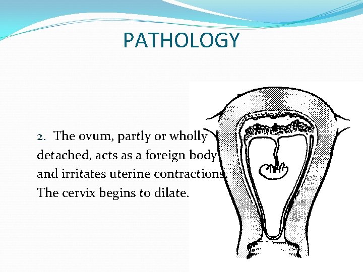 Lecture 8 ECTOPIC PREGNANCY ABORTION Prof Vlad TICA