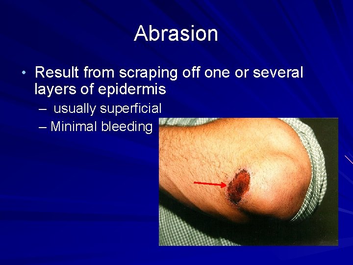 Fractures Wounds Abrasion Result from scraping off one