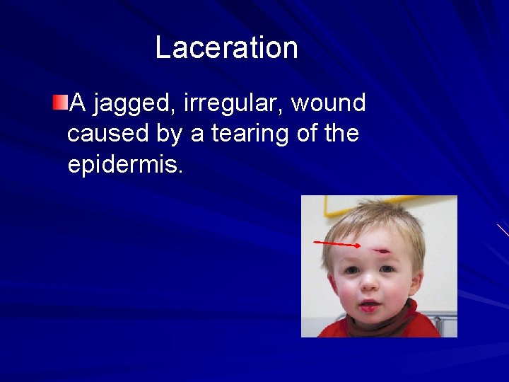 Fractures Wounds Abrasion Result from scraping off one