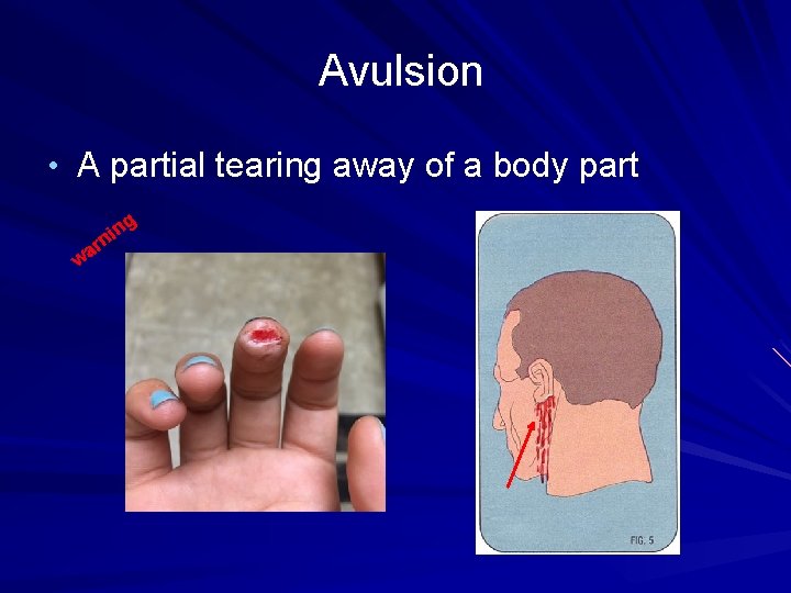 Fractures Wounds Abrasion Result from scraping off one