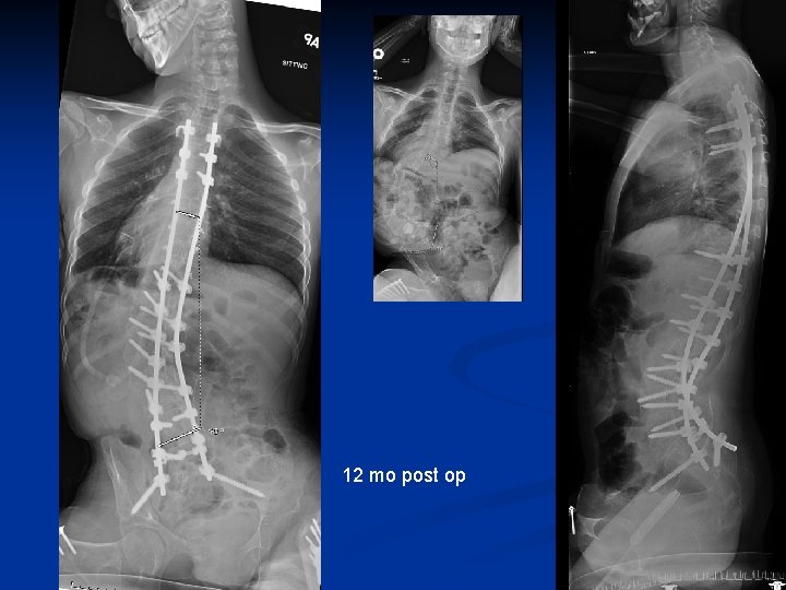 Tips and Tricks Intraoperative Spine Traction Using Distractor