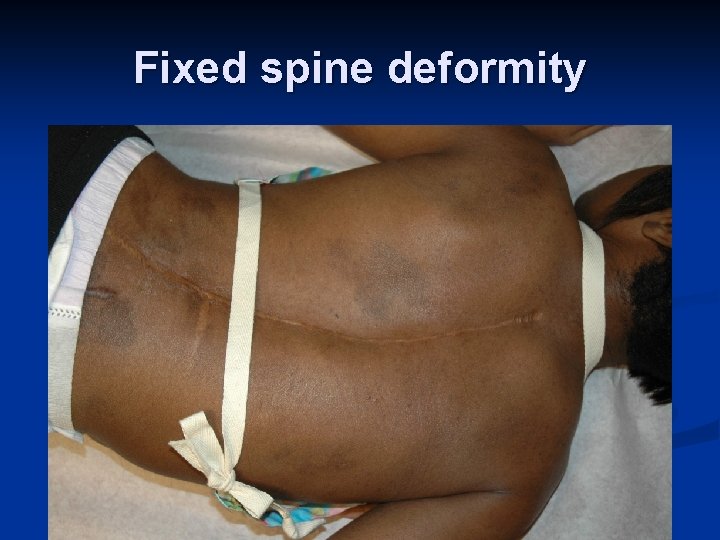 Tips and Tricks Intraoperative Spine Traction Using Distractor