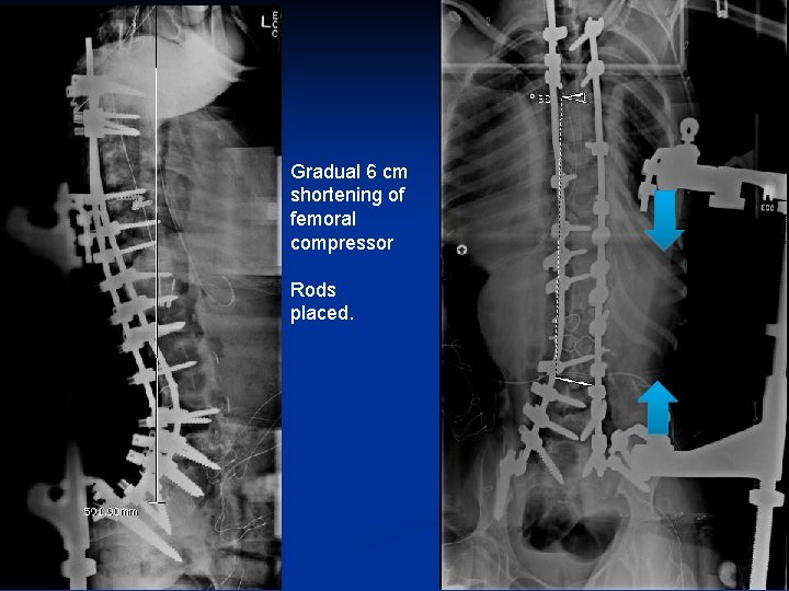 Tips and Tricks Intraoperative Spine Traction Using Distractor