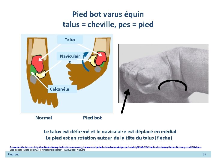 Pied bot varus e quin idiopathique pied bot