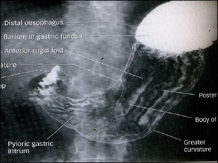 ANATOMY OF STOMACH NORMAL BARIUM MEAL ANATOMY OF