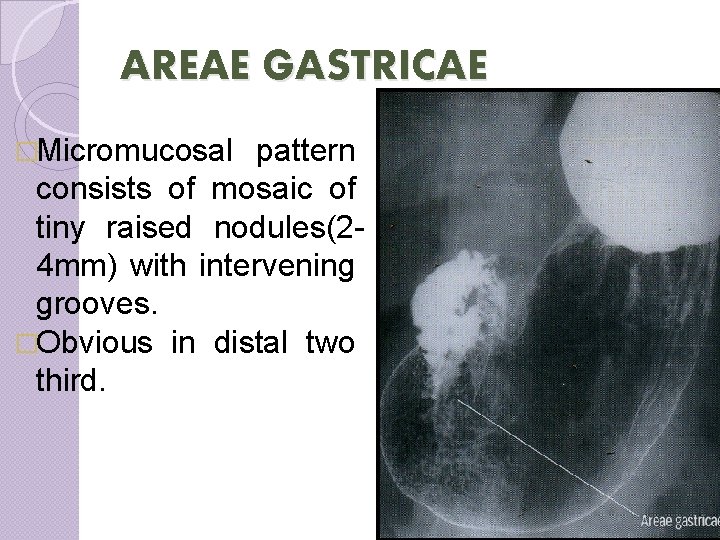 ANATOMY OF STOMACH NORMAL BARIUM MEAL ANATOMY OF