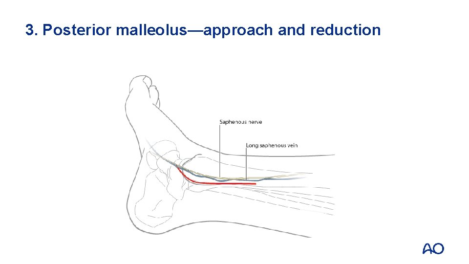 Malleolar fractures Anna Ekman Lena Brauer Learning outcomes