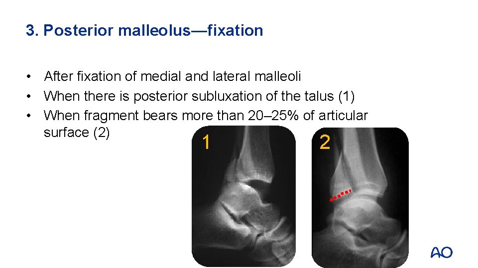 Malleolar fractures Anna Ekman Lena Brauer Learning outcomes
