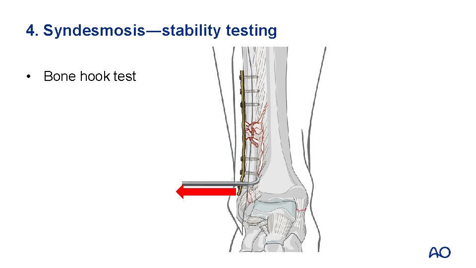 Malleolar fractures Anna Ekman Lena Brauer Learning outcomes