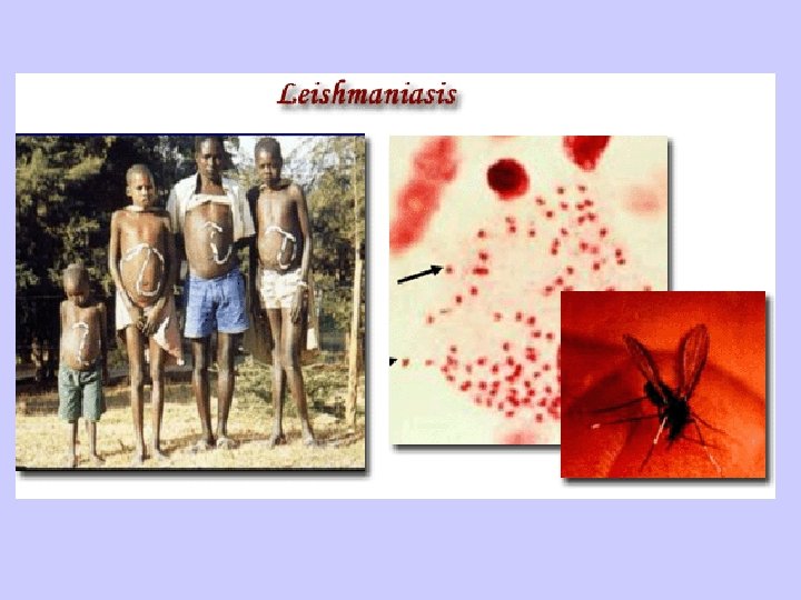 Leishmaniasis is a parasitic disease caused by the