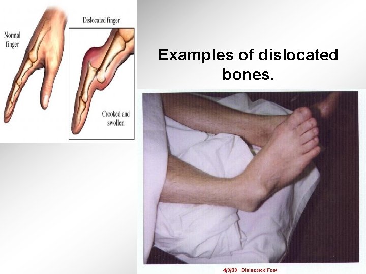 Bones and Trauma Bone Information After a determination