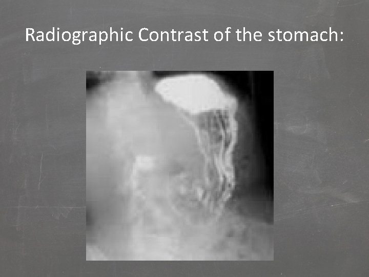Stomach Barium Meal RT205 B MIDTERM What is