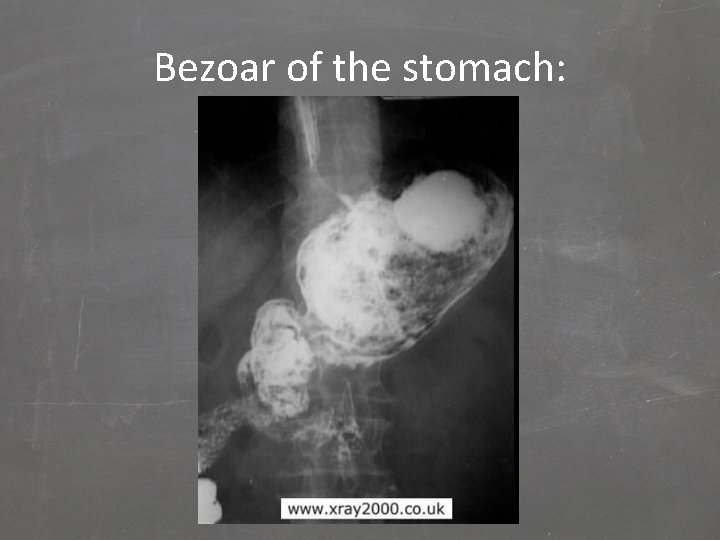 Stomach Barium Meal RT205 B MIDTERM What is