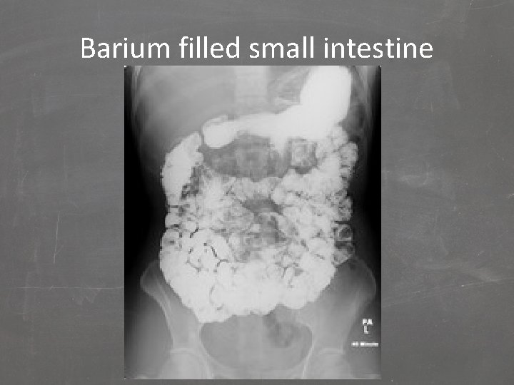 Stomach Barium Meal RT205 B MIDTERM What is