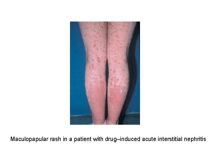 TUBULONTERSTTAL DSEASE Prof Dr Glin Kantarc Yeditepe University