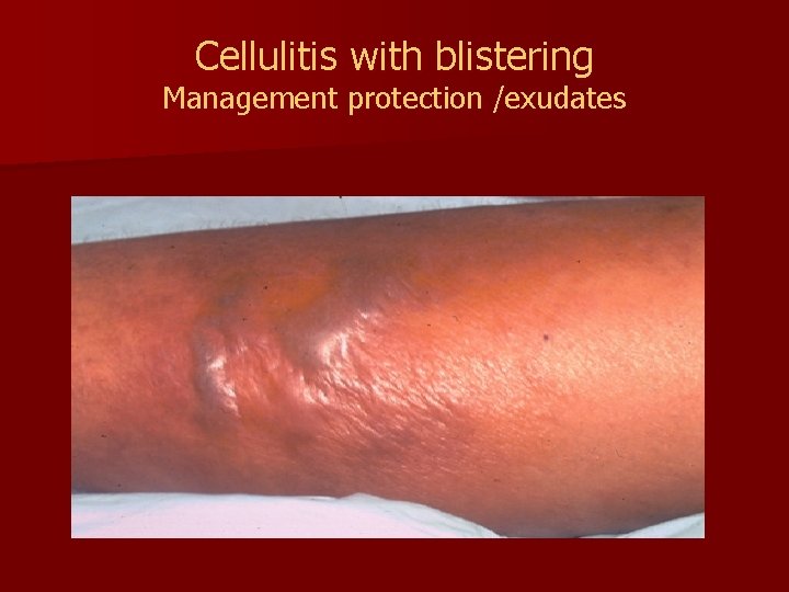 Cellulitis Fungal Infection Venous Eczema Presented by Natalie