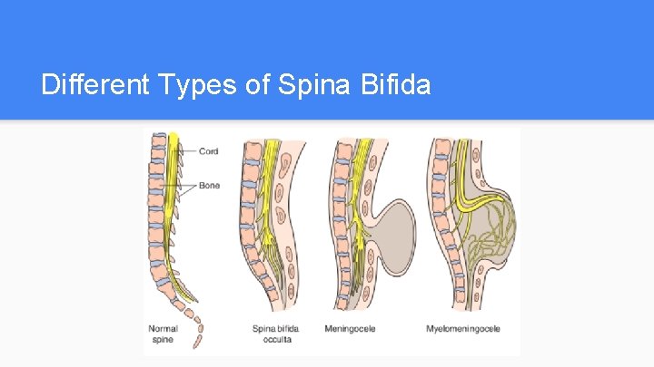 Spina Bifida Princepal S Buttar Manjot Bagri Cavan