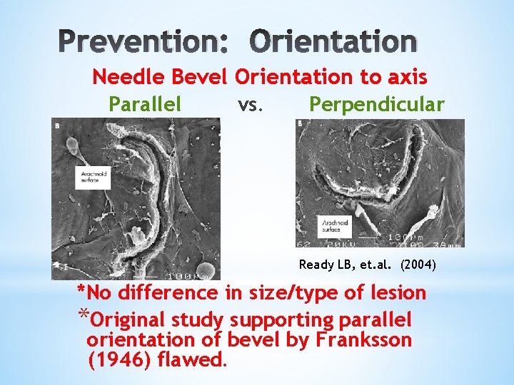 Post Dural Puncture Headache Prevention Assessment and Treatment