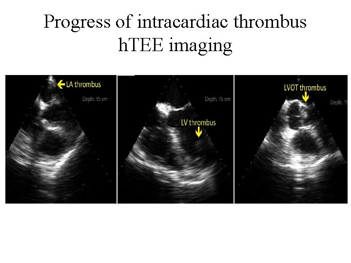 Left ventricular thrombus and its complications during venoarterial