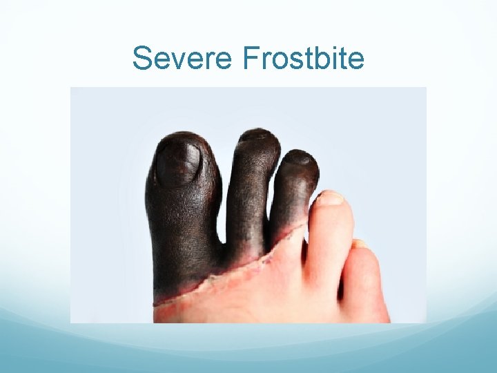 COLD EMERGENCIES BRRRRRR Objectives Review the pathophysiology of