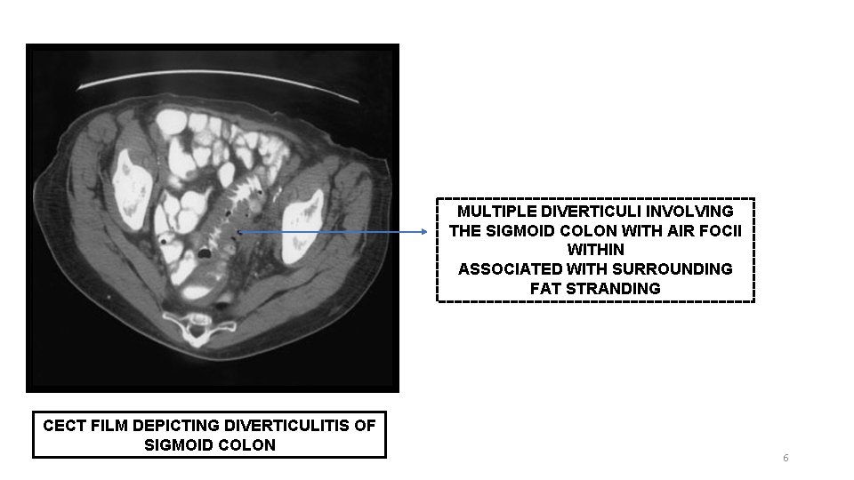 MANAGEMENT OF A RARE CASE OF SIGMOID DIVERTICULAR