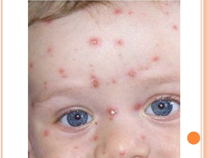 CASO CLNICO GIANOTTI CROSTI ACRODERMATITE PAPULAR DA INF