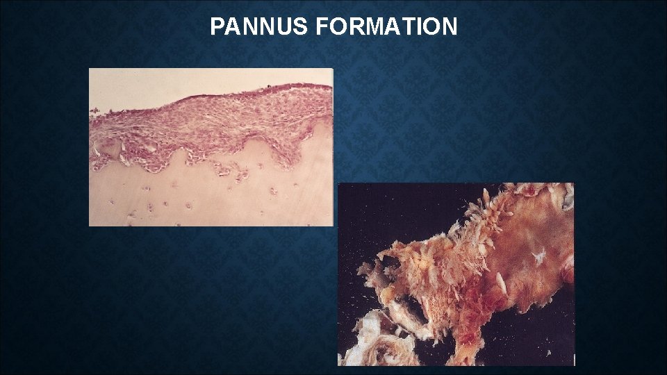 RHEUMATOID ARTHRITIS Sam R Dalvi MD Associate Professor