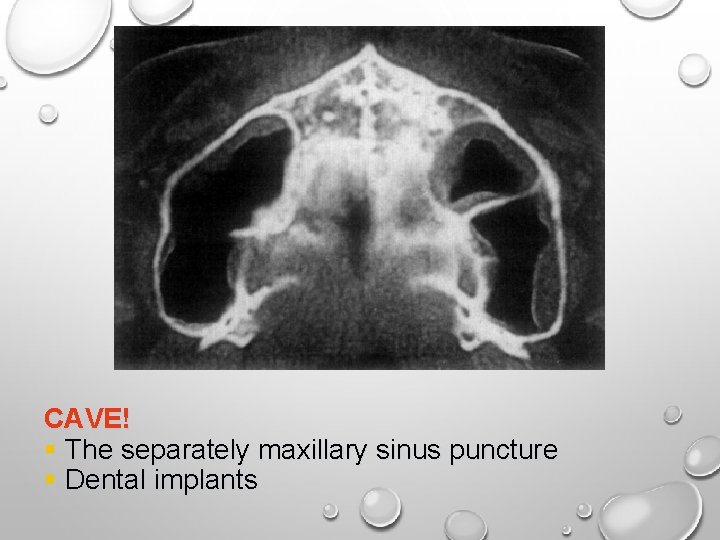 MAXILLA Upper jaw Anatomy Clinical notes Dentoalveolar topography