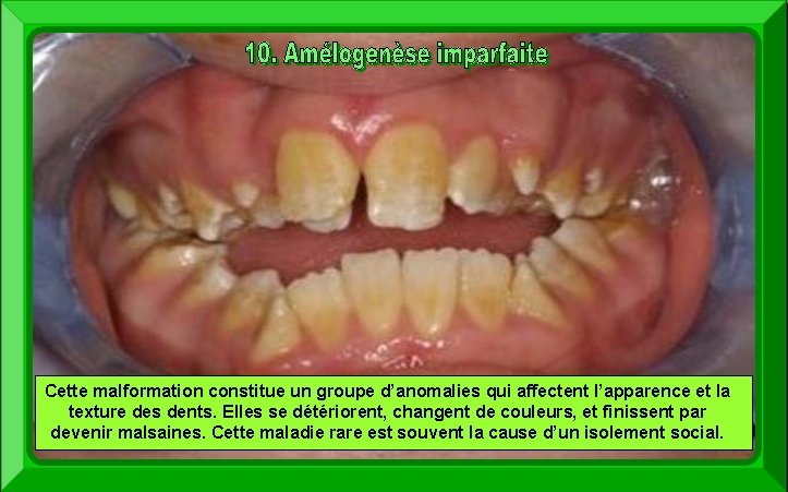 SONORE AUTOMATIQUE Due un drglement hormonal les sujets