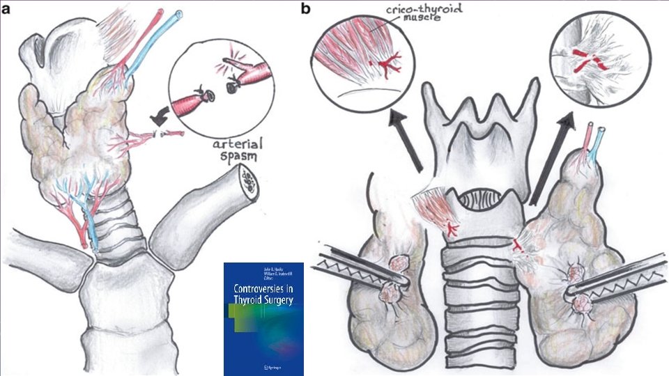 PARATIROIDE RLN Potential role for carbon nanoparticles identification