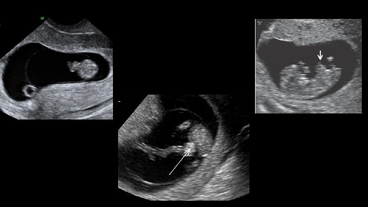 Fetal Abdominal Anomalies DMS 443 By Lauren Sanchez