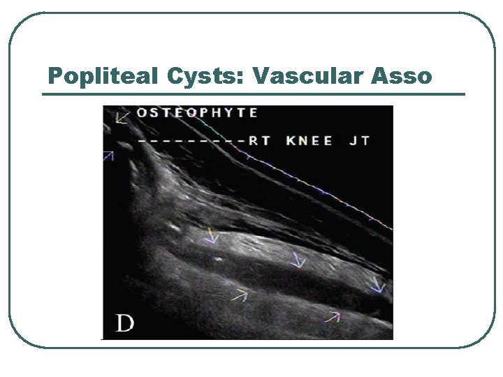 Tendinitis and Bursitis around knee joint Role of