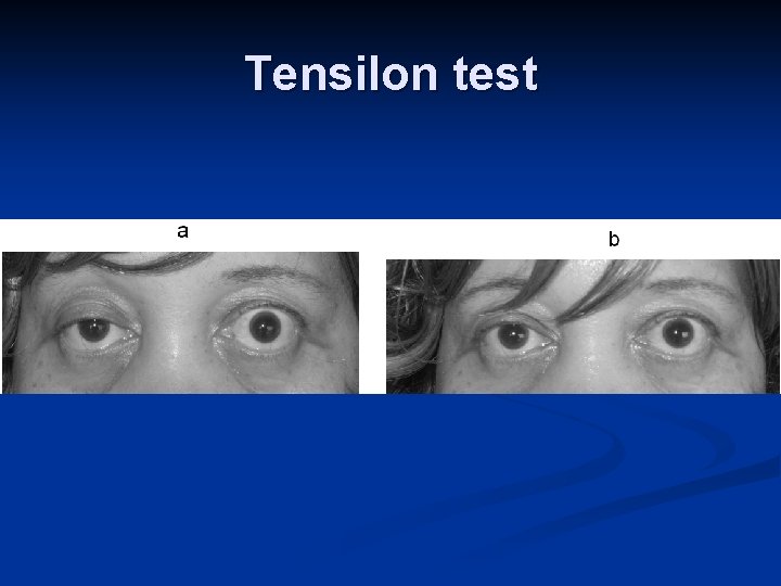 Neuromuscular Junction Disorders Abdullah AlSalti R 3 AHD