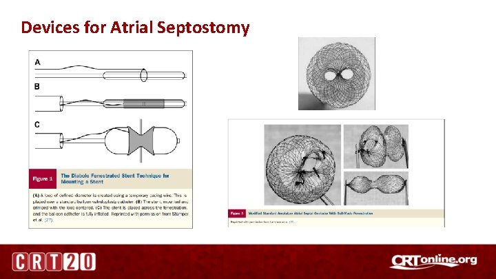 Implantable Devices for Pulmonary Hypertension William T Abraham