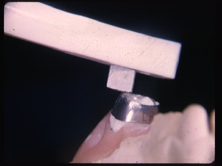 MANAGING THE ARCH CIRCUMFERENCE Band Adaptation and Impressions