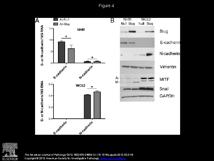 Slug Expression during Melanoma Progression Stephanie H Shirley