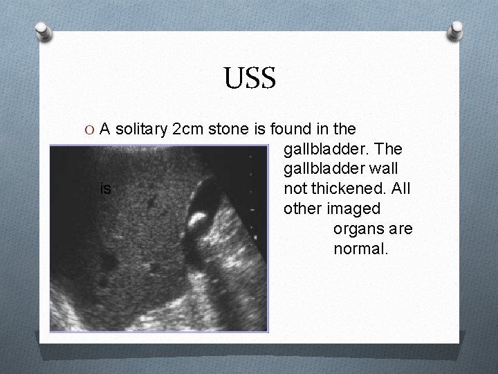 A case of upper abdo pain Joanna Wykes