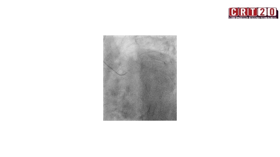 A complex PCI case February 24 2020 Charles