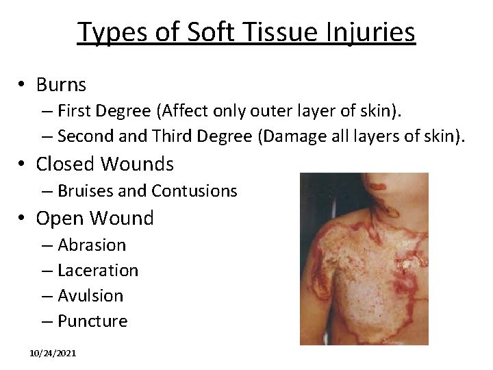 Soft Tissue Injuries 10242021 What are Soft Tissues