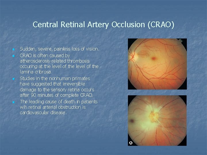 RETINAL VASCULAR DISEASES Dr Sinan Tatlpnar Objective n