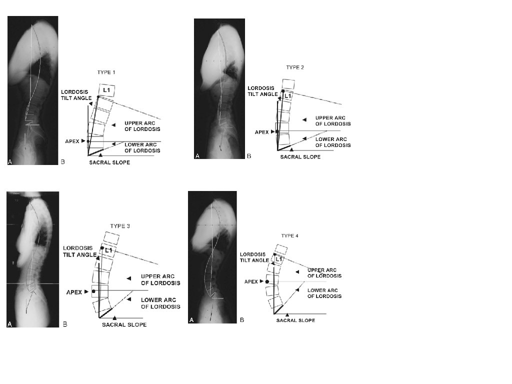 Cyphose Dorsale valeurs normales Stphane Wolff GES 2015