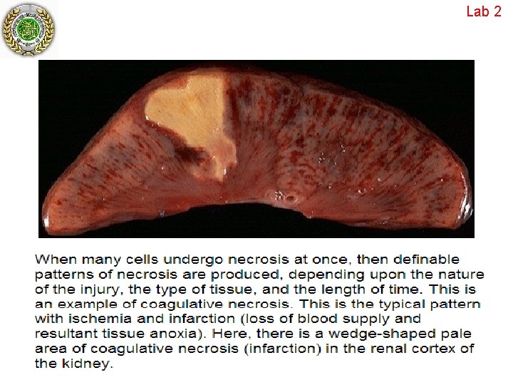 Lab 2 Practical Pathophysiology Stage 3 Collage of
