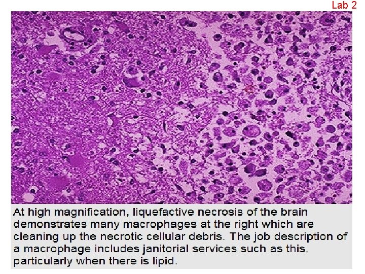 Lab 2 Practical Pathophysiology Stage 3 Collage of