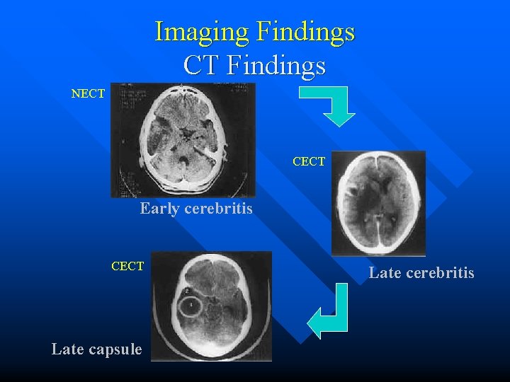 Brain Abscess 2006 03 14 Definitions Focal pyogenic